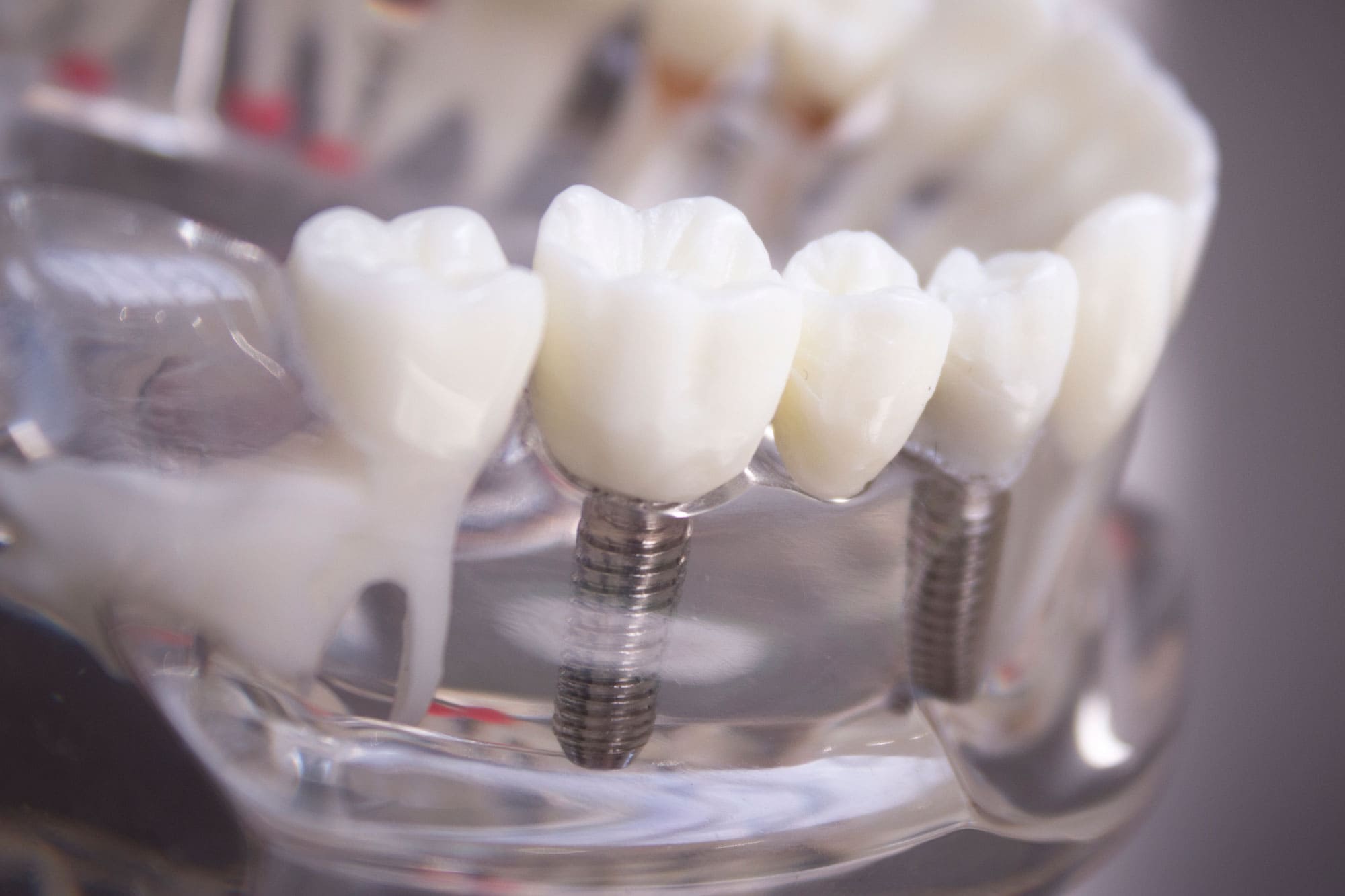 Why Spain Is a European Hub for Advanced Dental Implantology - City ...